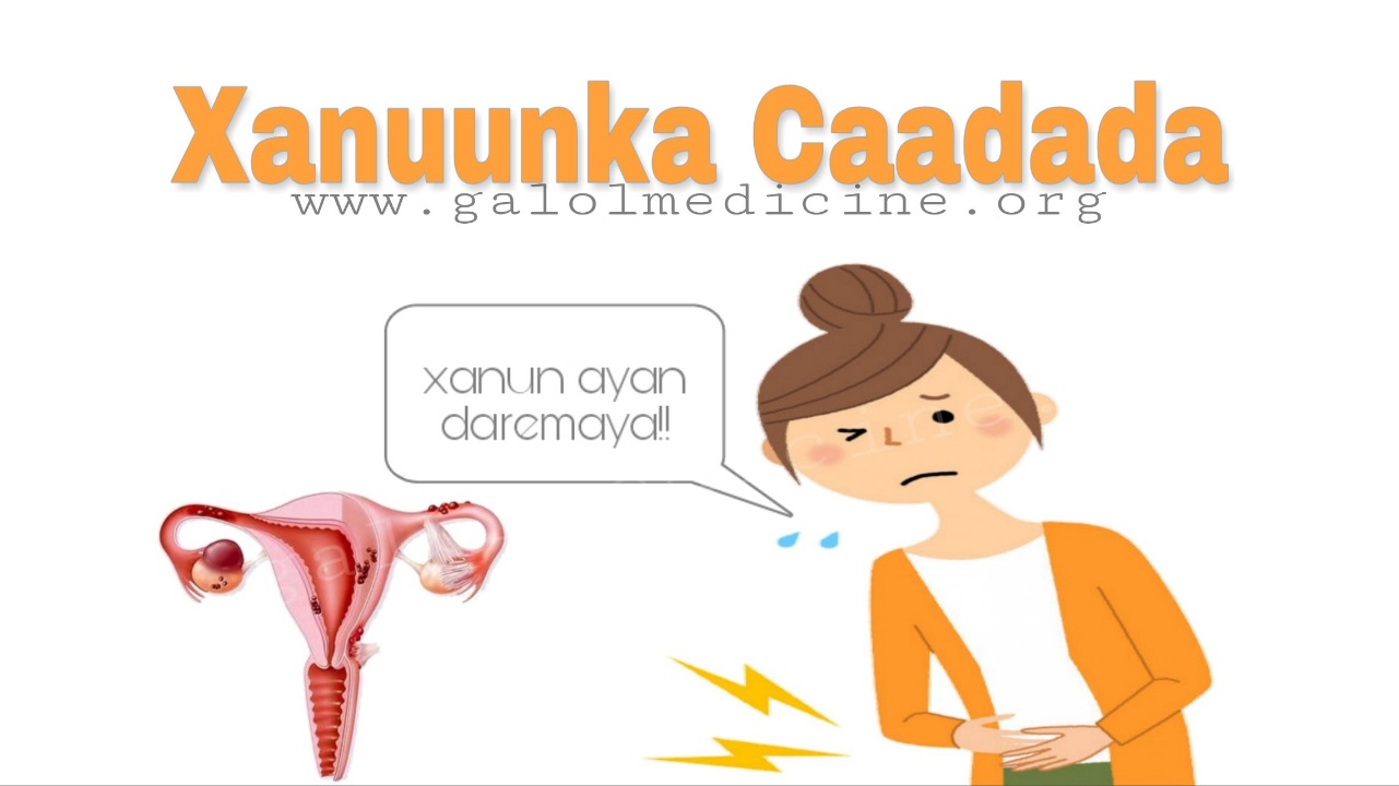 Xanuunka Caadada - Dysmenorrhea | Galolmedicine